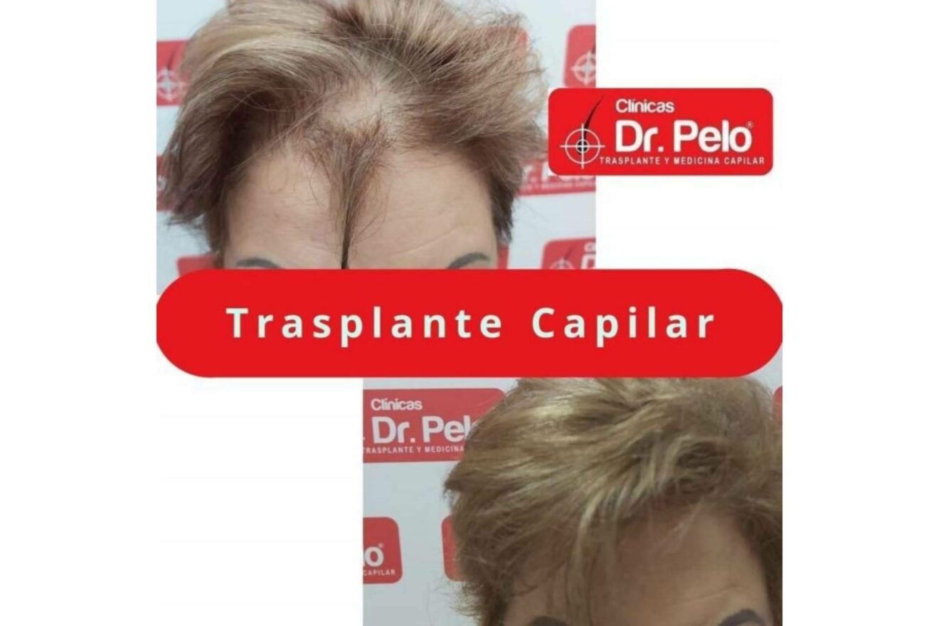 ¿Cómo frenar las entradas en el pelo gracias a las Clínicas Dr. Pelo ...
